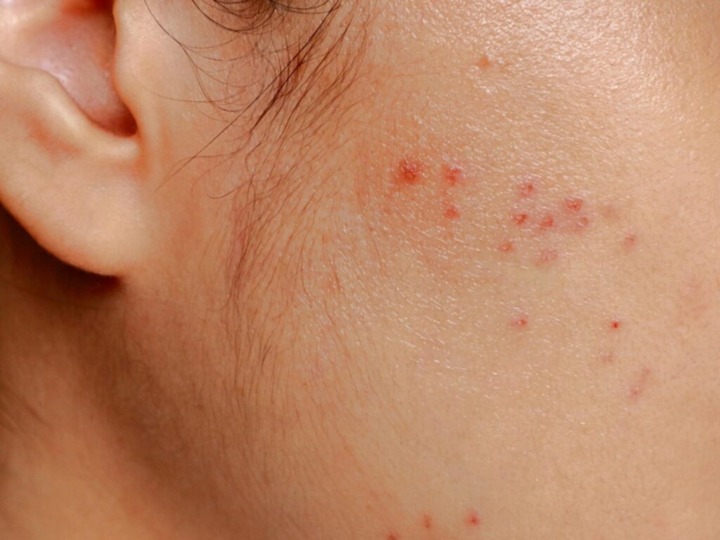 Dermata'nın akne ilacı klinik denemelerden geçti - Midas